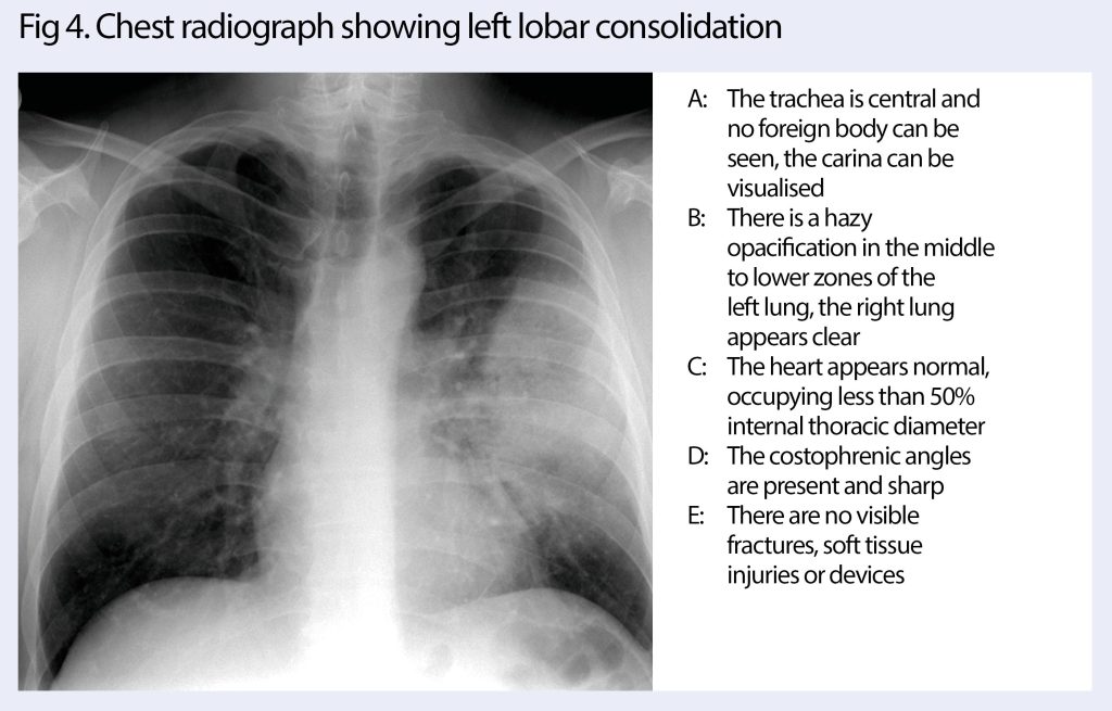 How to interpret chest radiographs (X-rays): a systematic approach ...