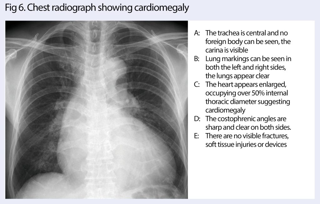 How to interpret chest radiographs (X-rays): a systematic approach ...